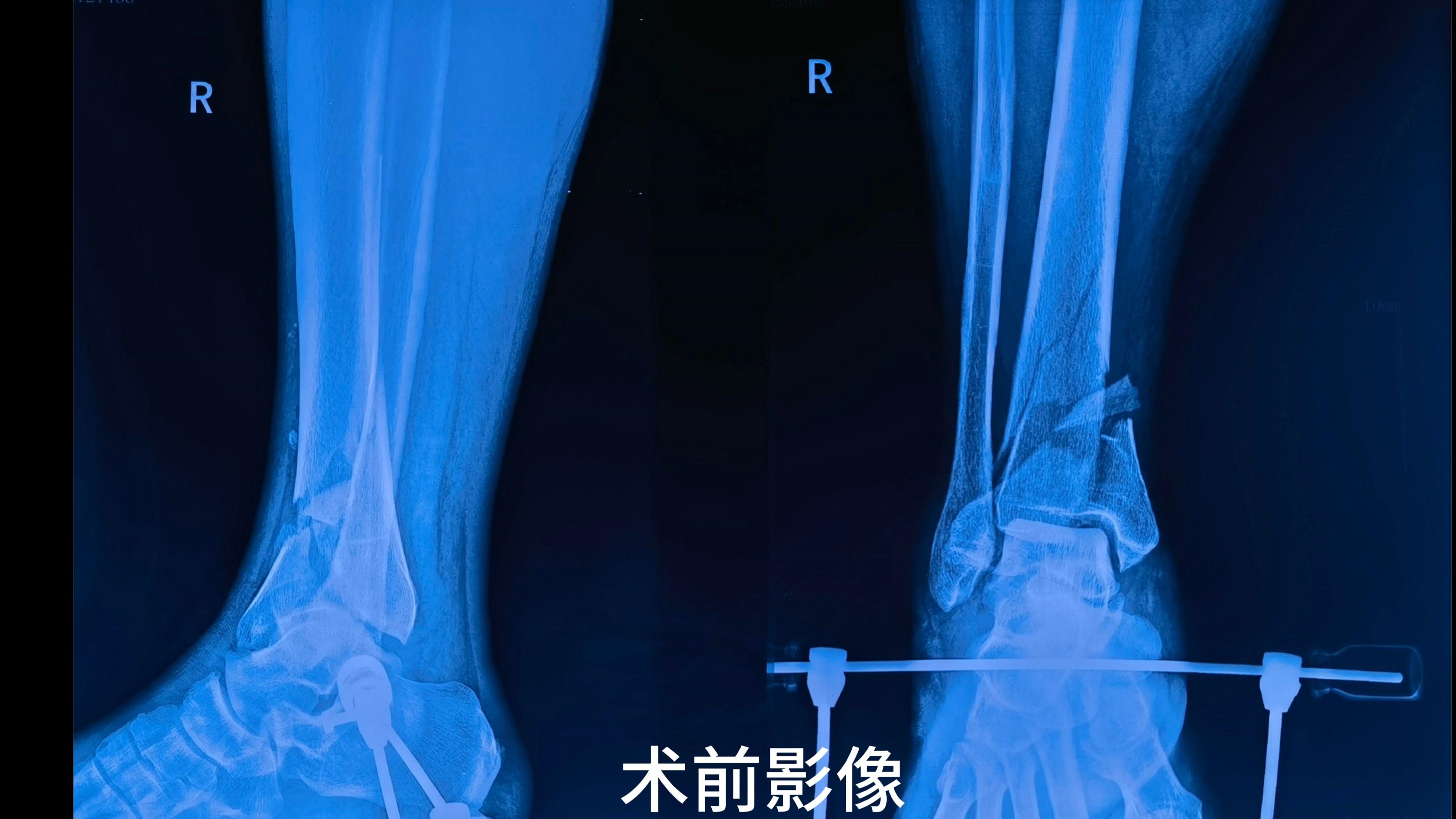 手术教学视频:右pilon骨折切复内固定术