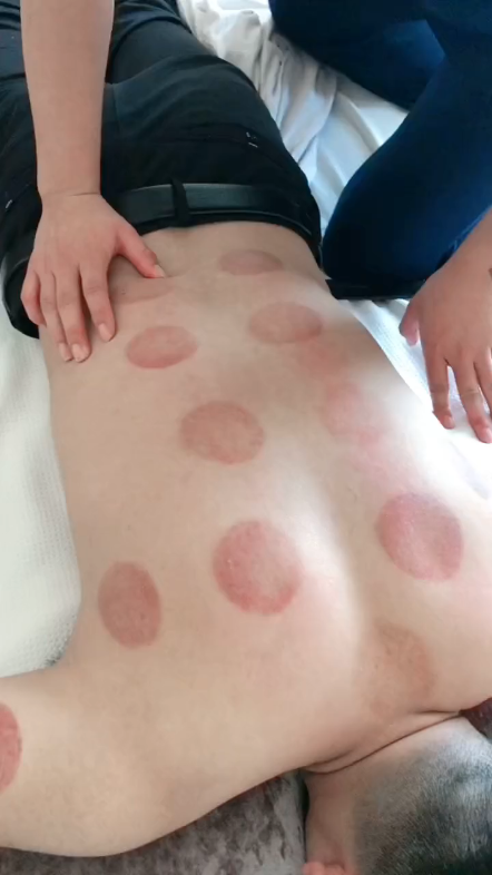 捏脊是用拇指指腹与食指、中指指腹对合,挟