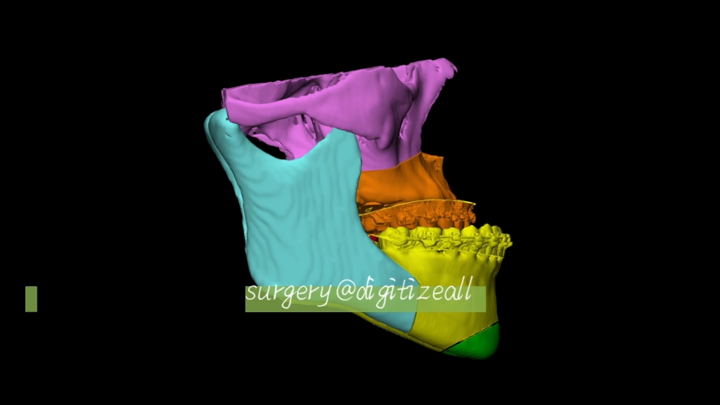 mimics正颌手术截骨 美学设计