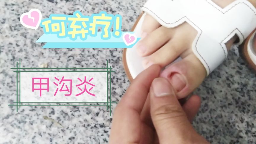 脚长甲沟炎,医生看了说:用碘伏消下毒就行,这样处理靠谱吗