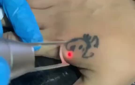 超皮秒洗纹身第一次皮秒洗纹身