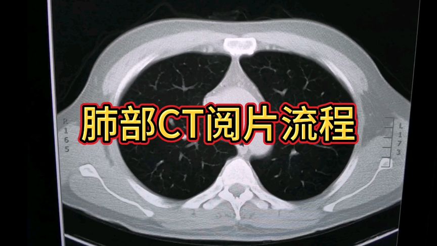 胸部CT有几个窗位,各窗位阅片大致流程或顺序是什么,你们知道吗