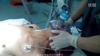 经鼻盲探气管内插管,牙齿松动( blind nasal Intubation)