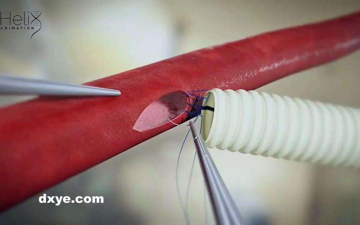 降落伞式血管吻合术-人体血管_合成移植物