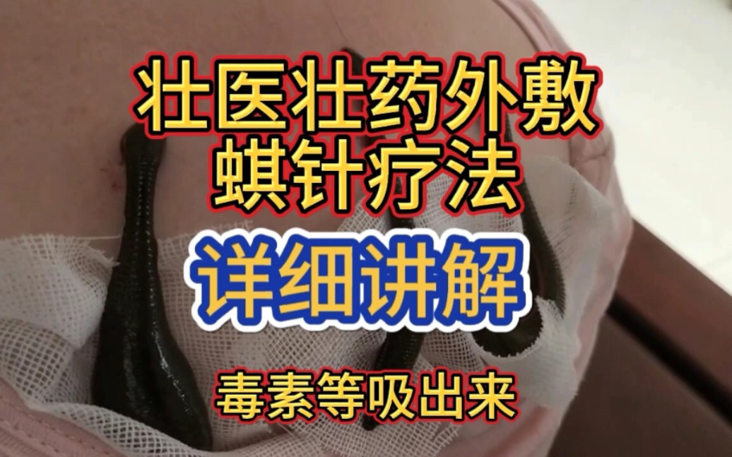 弘扬祖国传统医学 继承中医中药 广西壮医壮药外敷 蜞针疗法