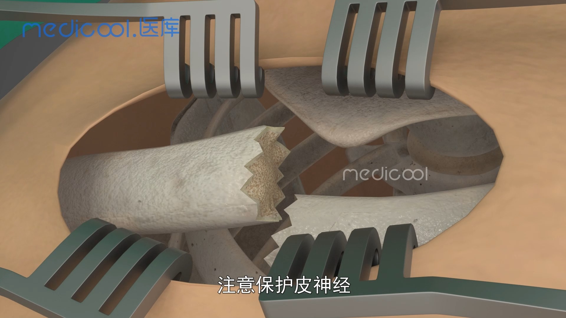 锁骨中段钢板螺钉内固定术,骨折切开复位内固定