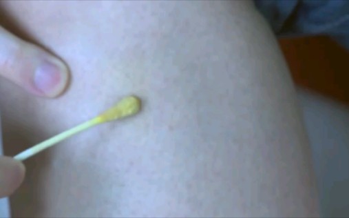血腥预警!足三里病变点刺血实操讲解