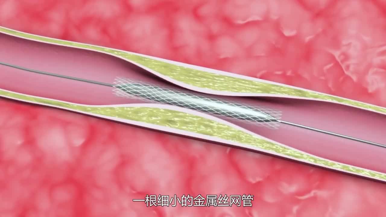 心脏支架如何工作?插入体内让血管扩张!