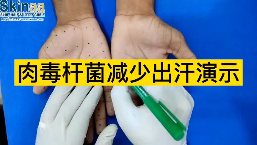 #手汗症 #我要上热门 肉毒杆菌实操