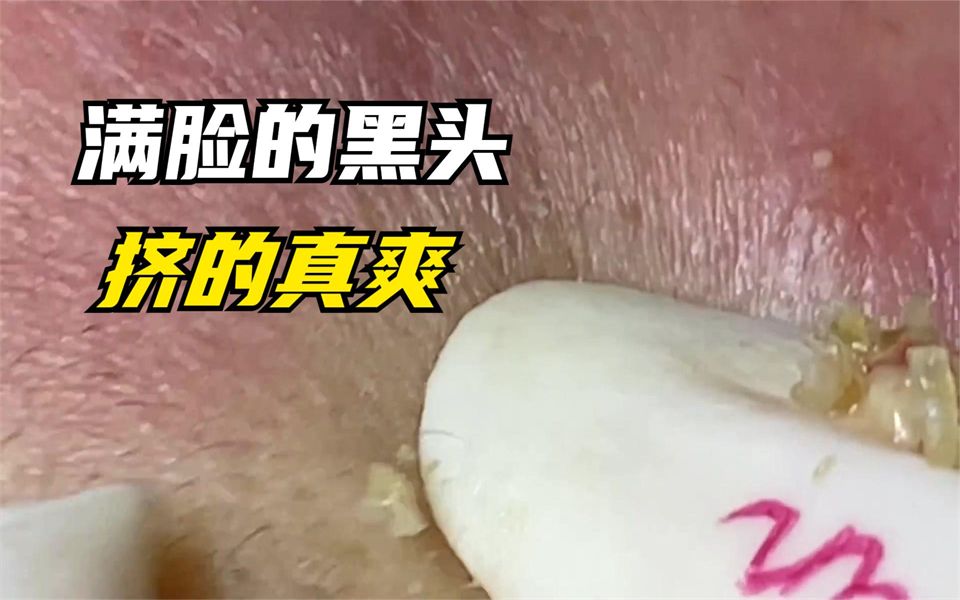 小姐姐满脸的黑头,女护理挤的那叫舒服