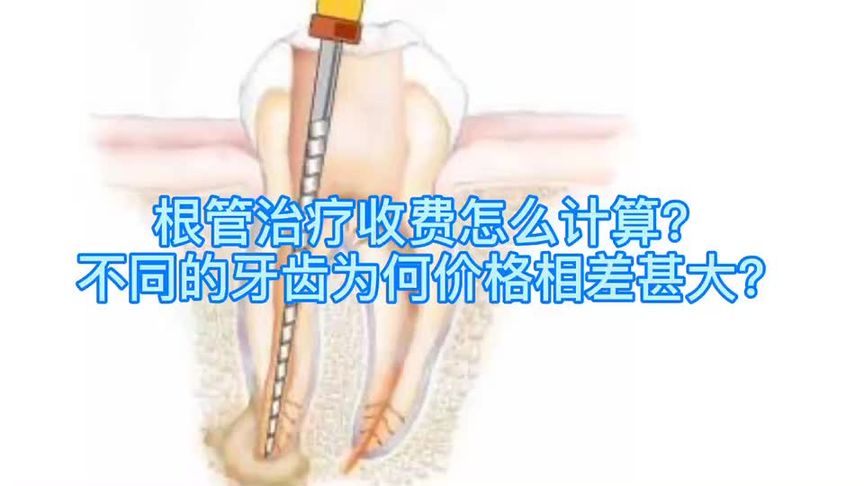根管治疗收费是如何计算的?为什么每颗牙齿的治疗价格不同?