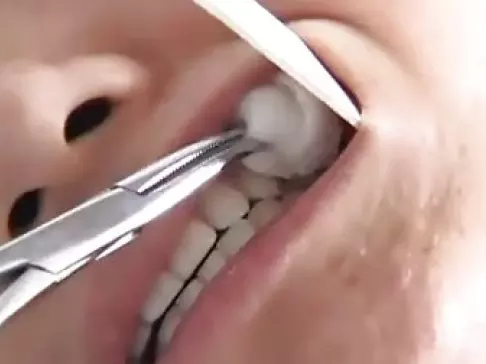 11 口腔护理技术 常用50项护理操作技术