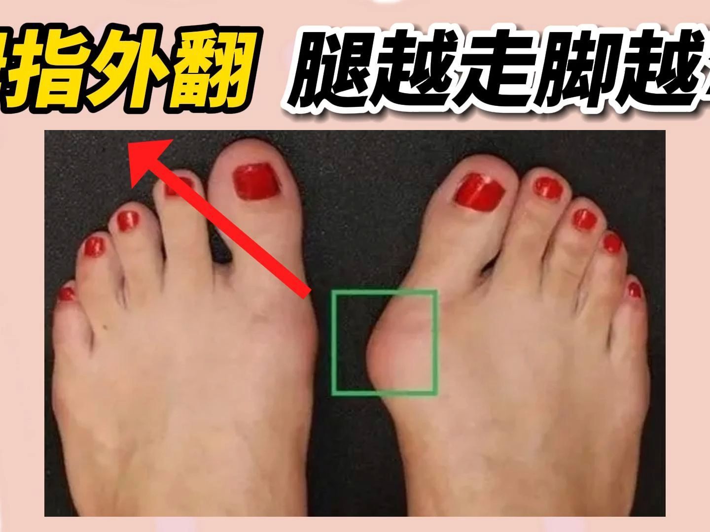 拇指外翻 腿越走脚越弯