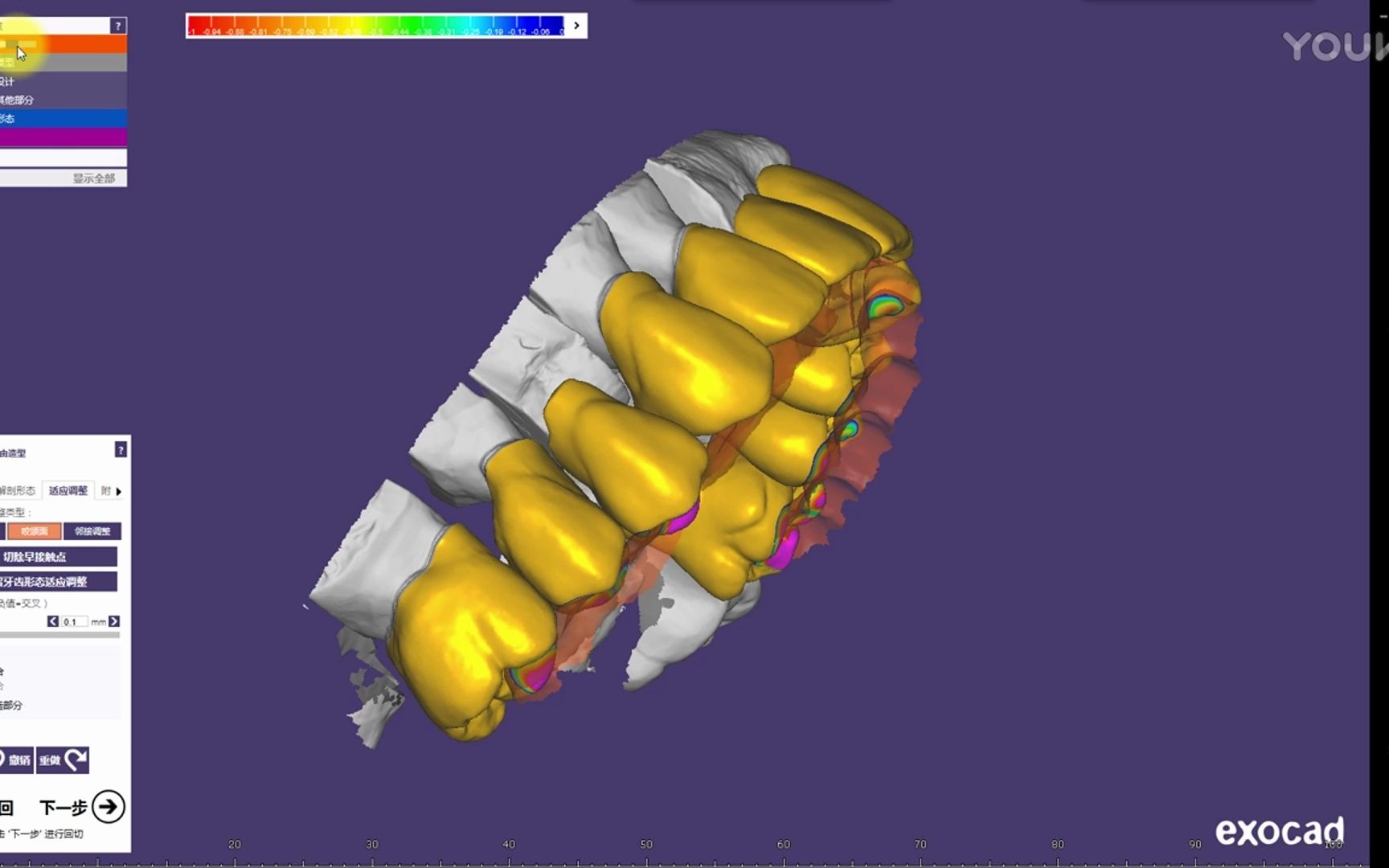 EXOCAD设计流程3-2