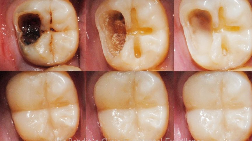没有更多的填充!新药“再生牙”他们自己治疗