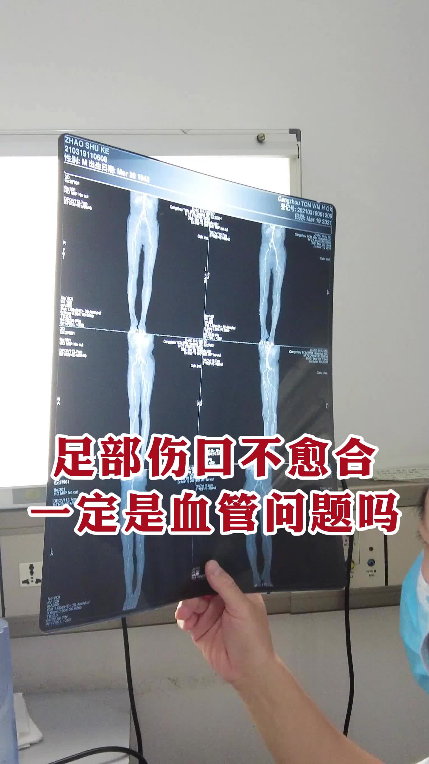 足部伤口不愈合 一定是血管问题吗?