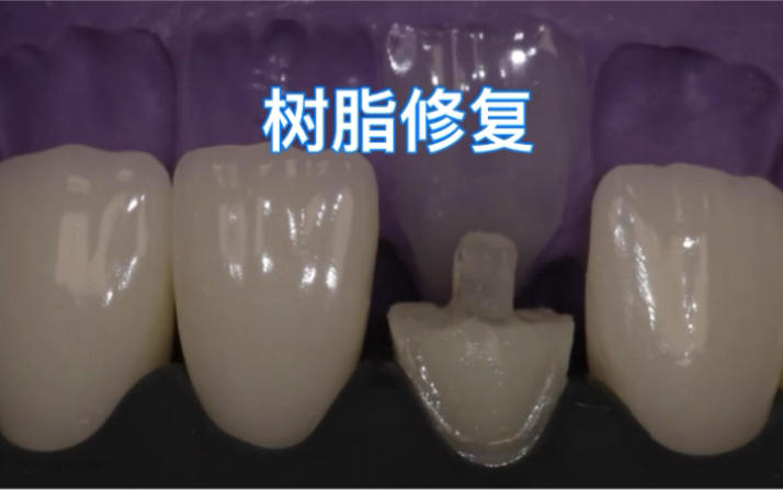 下颌中切牙纤维桩+树脂修复by Leonardo Muniz#树脂修复#牙匠之家