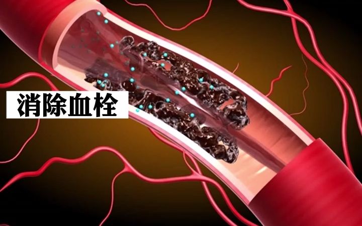 血管堵塞源头被发现了 消除血栓我来帮你
