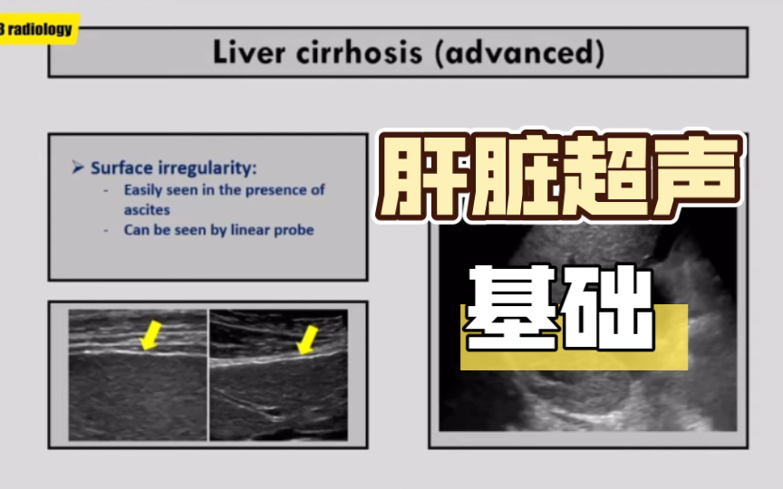 肝脏疾病在超声下的表现(肝脏超声基础)