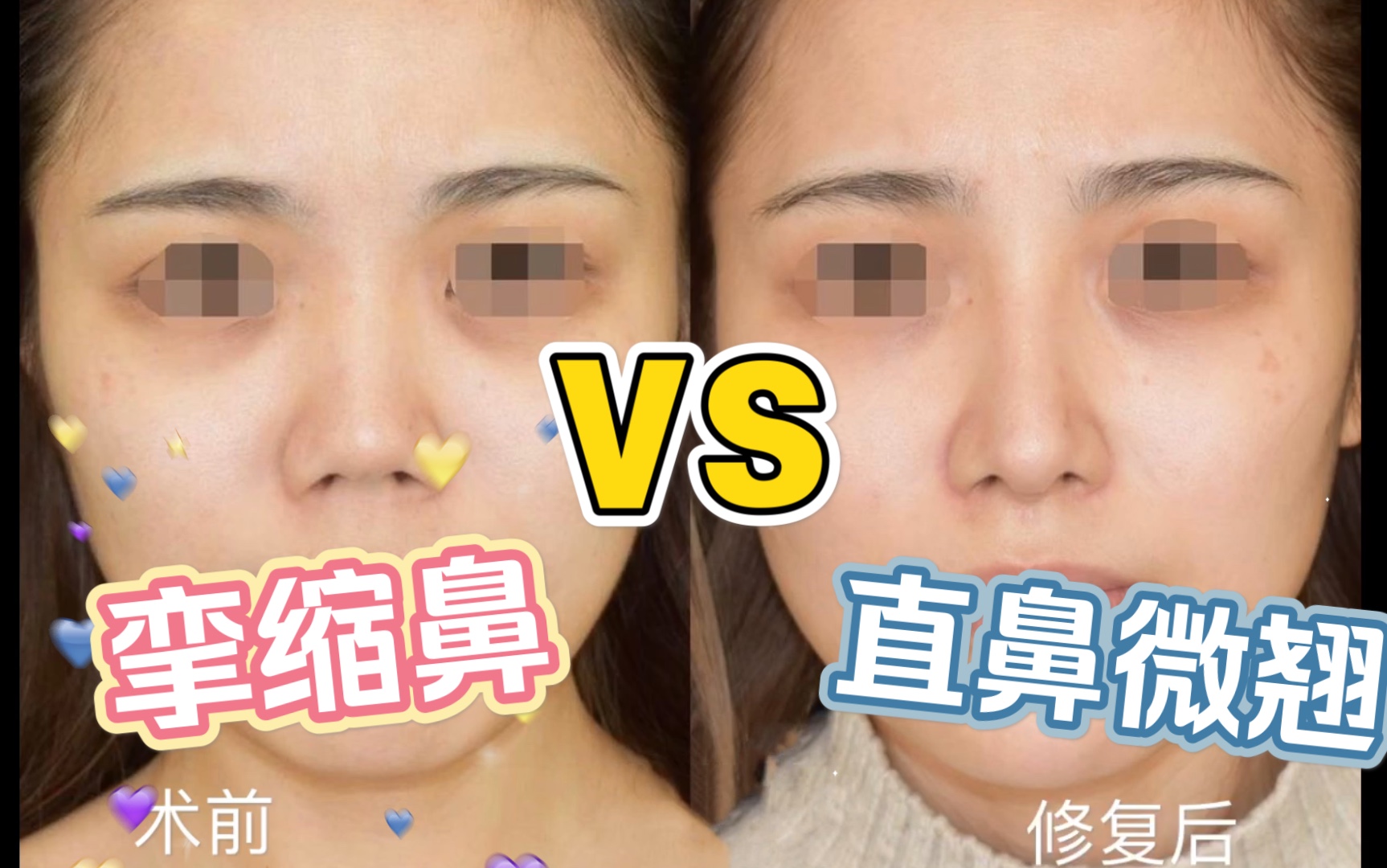 鼻子做毁了怎么办?造成鼻内组织疤痕增生拉扯着皮肤,导致鼻孔外漏,这...