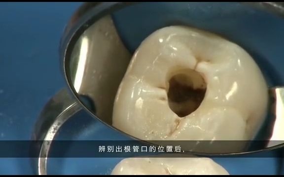 牙髓坏死根管治疗术全过程记录,拯救牙齿的最后一招