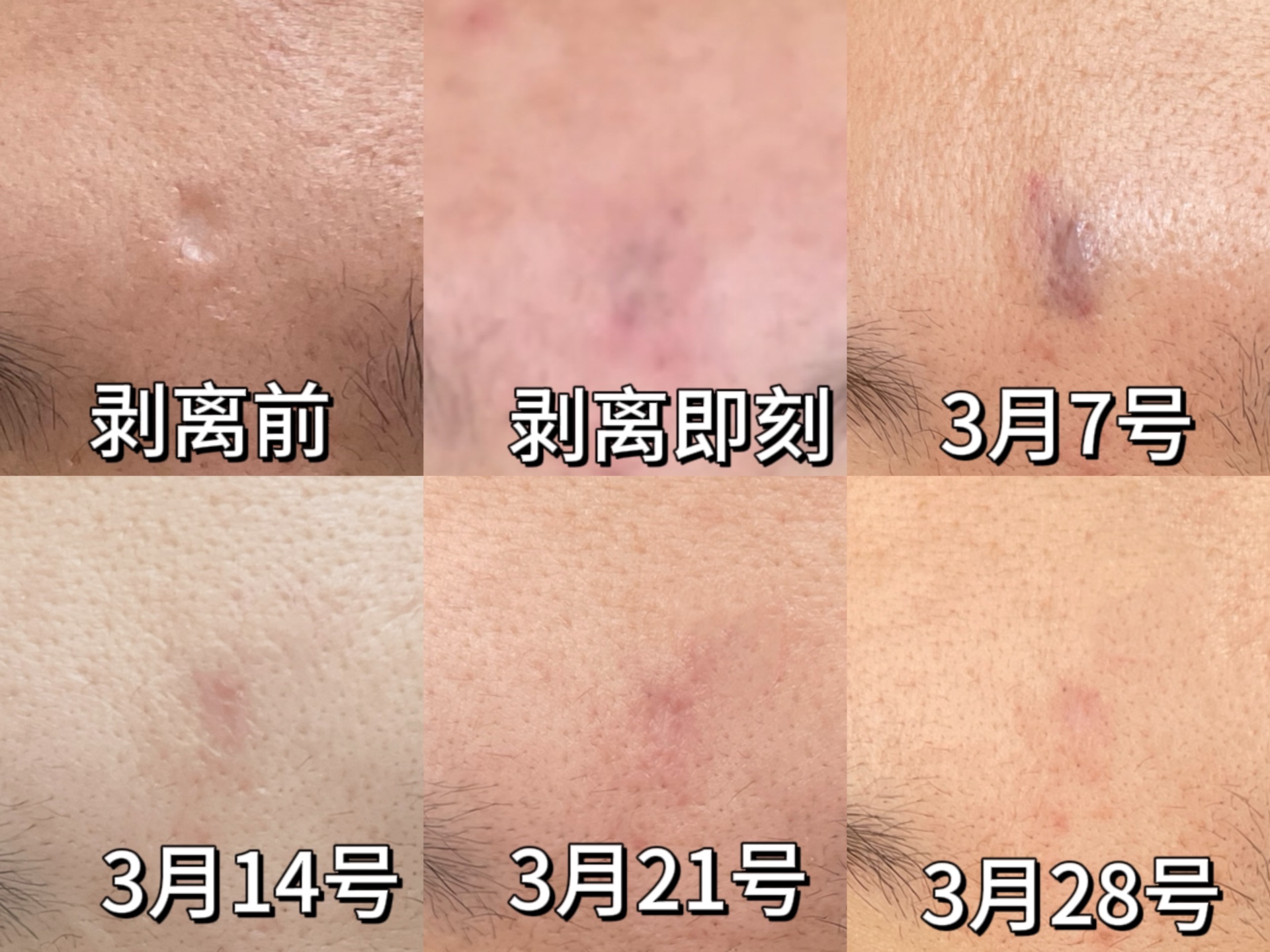 50块!终结了困扰我5年的水痘坑!皮下分离1个月完整记录分享!