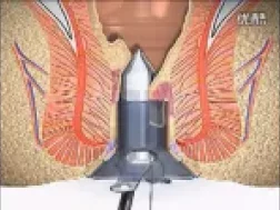 微创痔疮吻合器 PPH