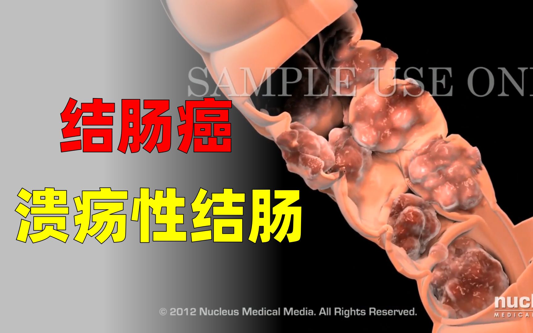 【3D医学动画】结肠癌根治术(中英双字幕)