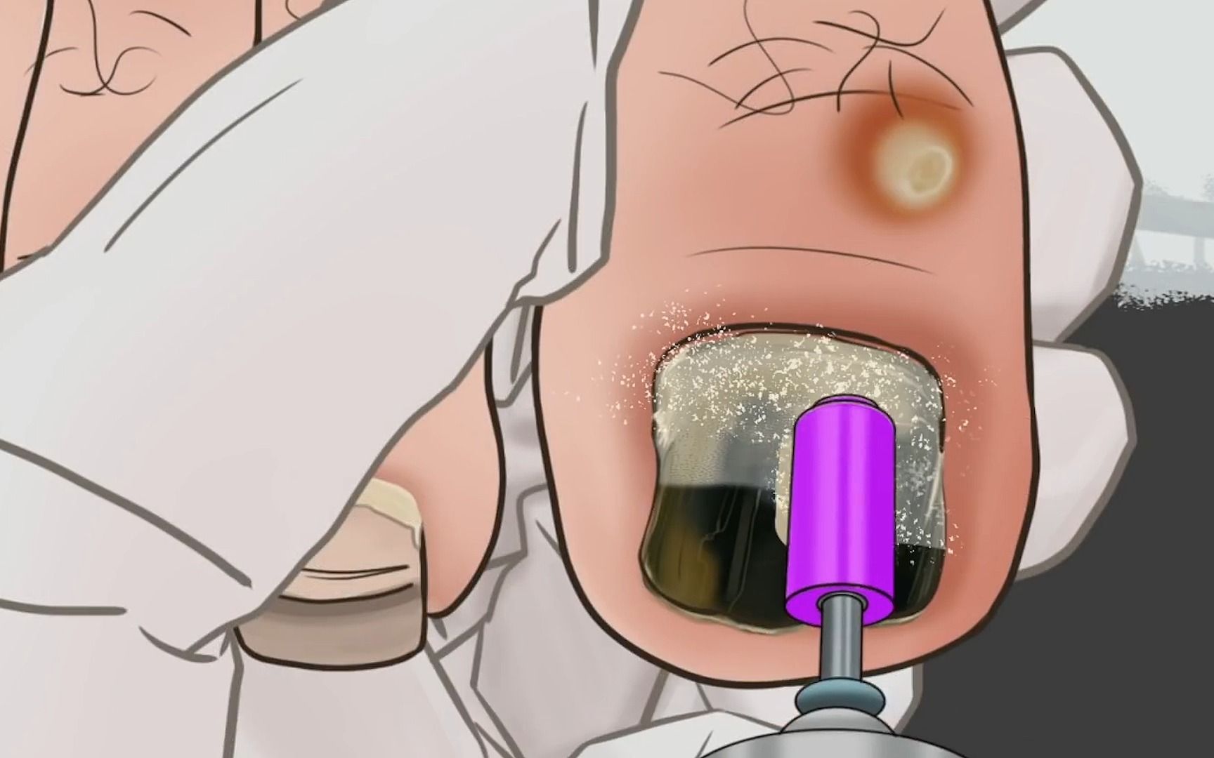 超解压修脚视频,看完强迫症好了!!