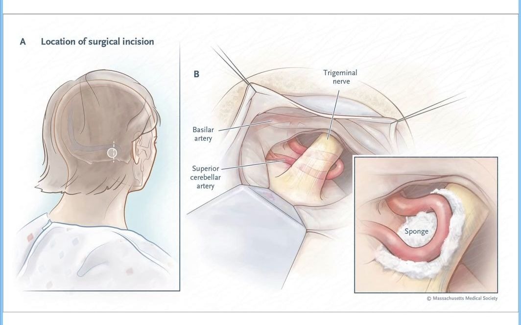 赏析【专业组 非商业插画类】微血管减压术 Microvascular De...