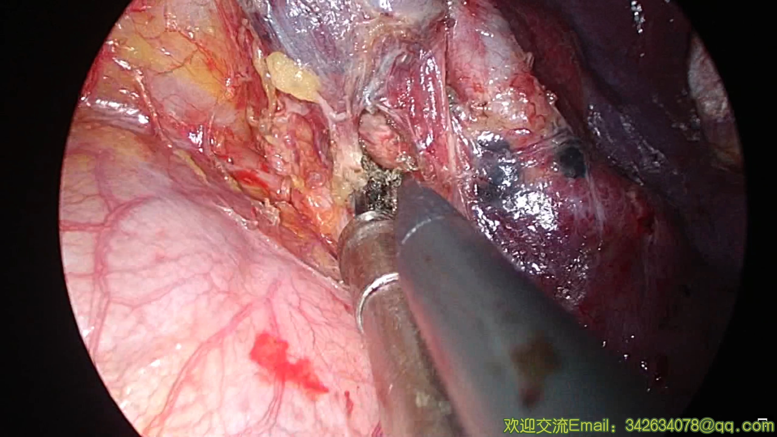 单孔胸腔镜 左肺上叶固有段切除+纵隔淋巴结清扫术 教学视频 ⭐⭐⭐...