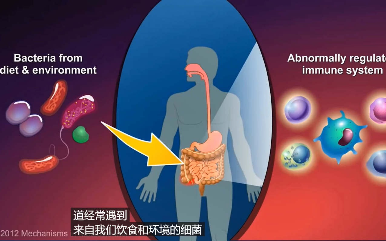 克罗恩病(Crohn's disease)AI机器学习风险预测模型,概述,流行病学统计...