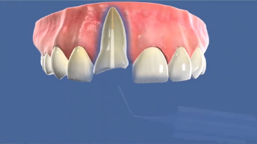 ...如果已经伤到牙神经也别发愁,可以根管治疗后,桩冠修复牙齿的功能哦!