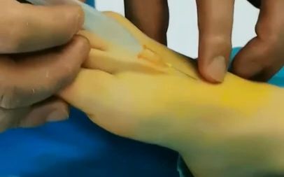 足背动脉采血穿刺血气采血-Dorsalis Pedis Artery Blood Gas Sampling