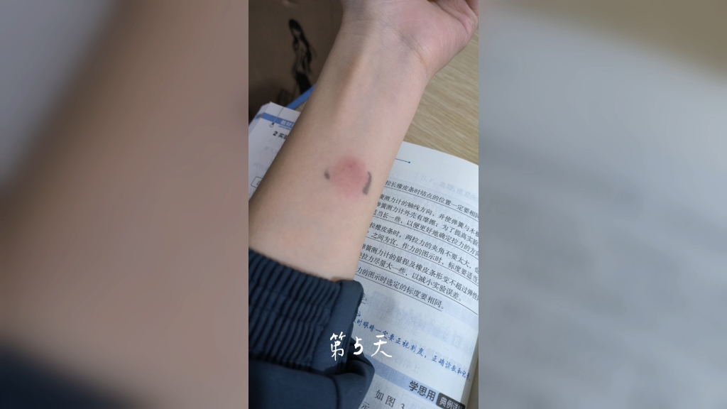 高中生做皮试,我请问一个星期了什么时候能恢复