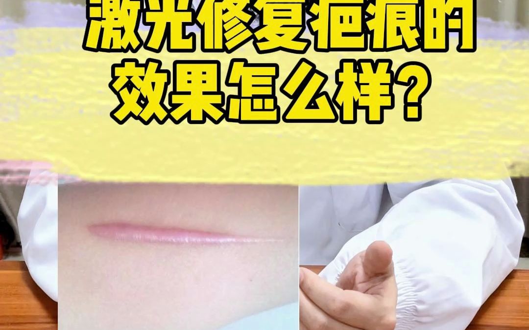 激光修复疤痕的效果怎么样?