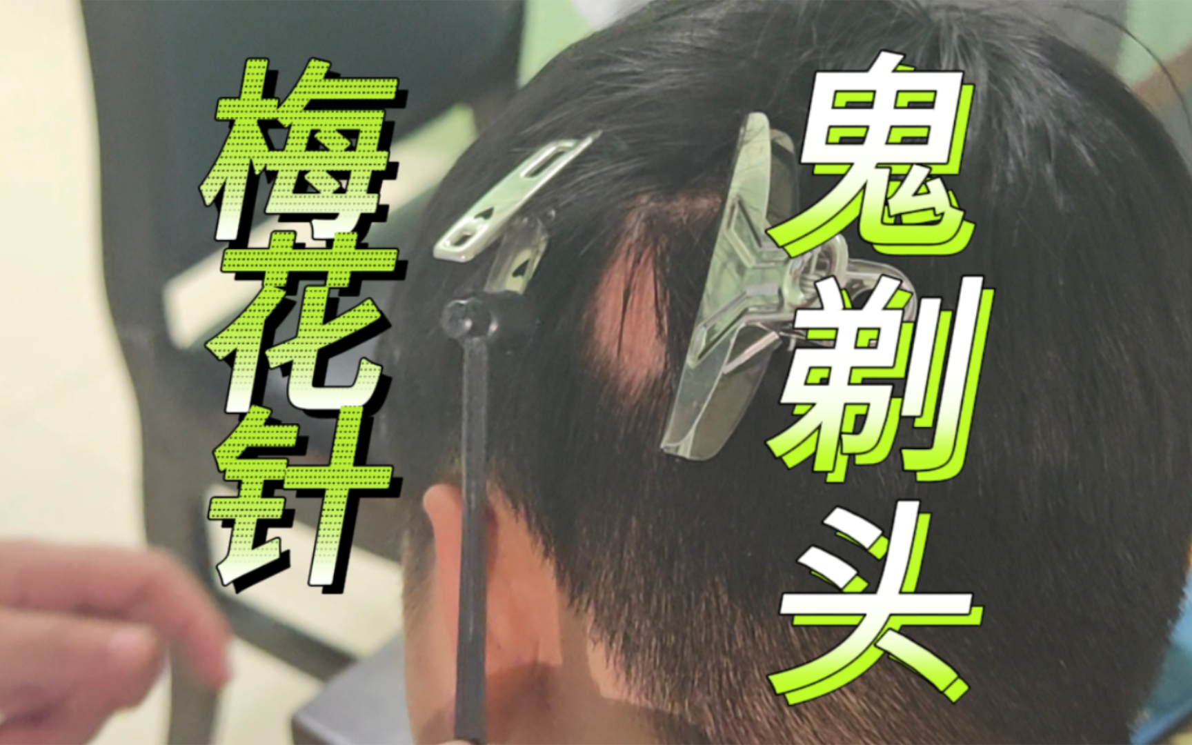梅花针 | 传说中的鬼剃头(斑秃)治疗