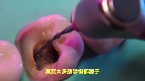 根管治疗全流程避坑指南!看完上牙椅不慌张,省下冤枉钱