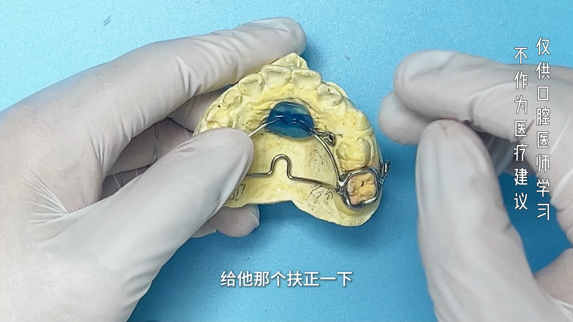 带牵引钩的Nance托横腭杆 活动矫治器 儿童牙齿矫治器