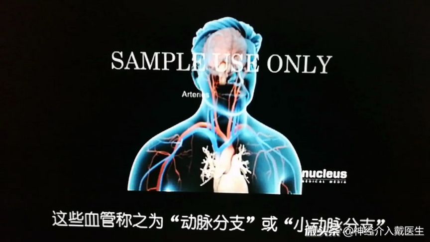 颅内动脉瘤的发生,破裂,开颅夹闭术及介入栓塞术动画片。