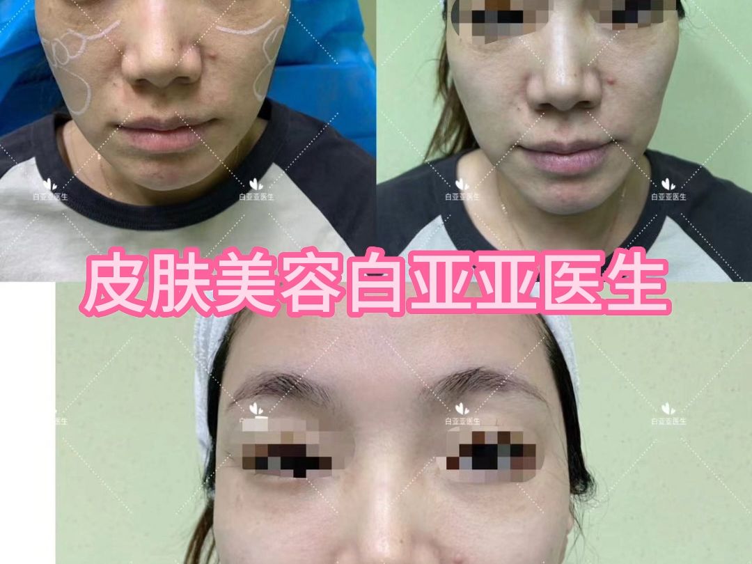 面部轮廓填充方法