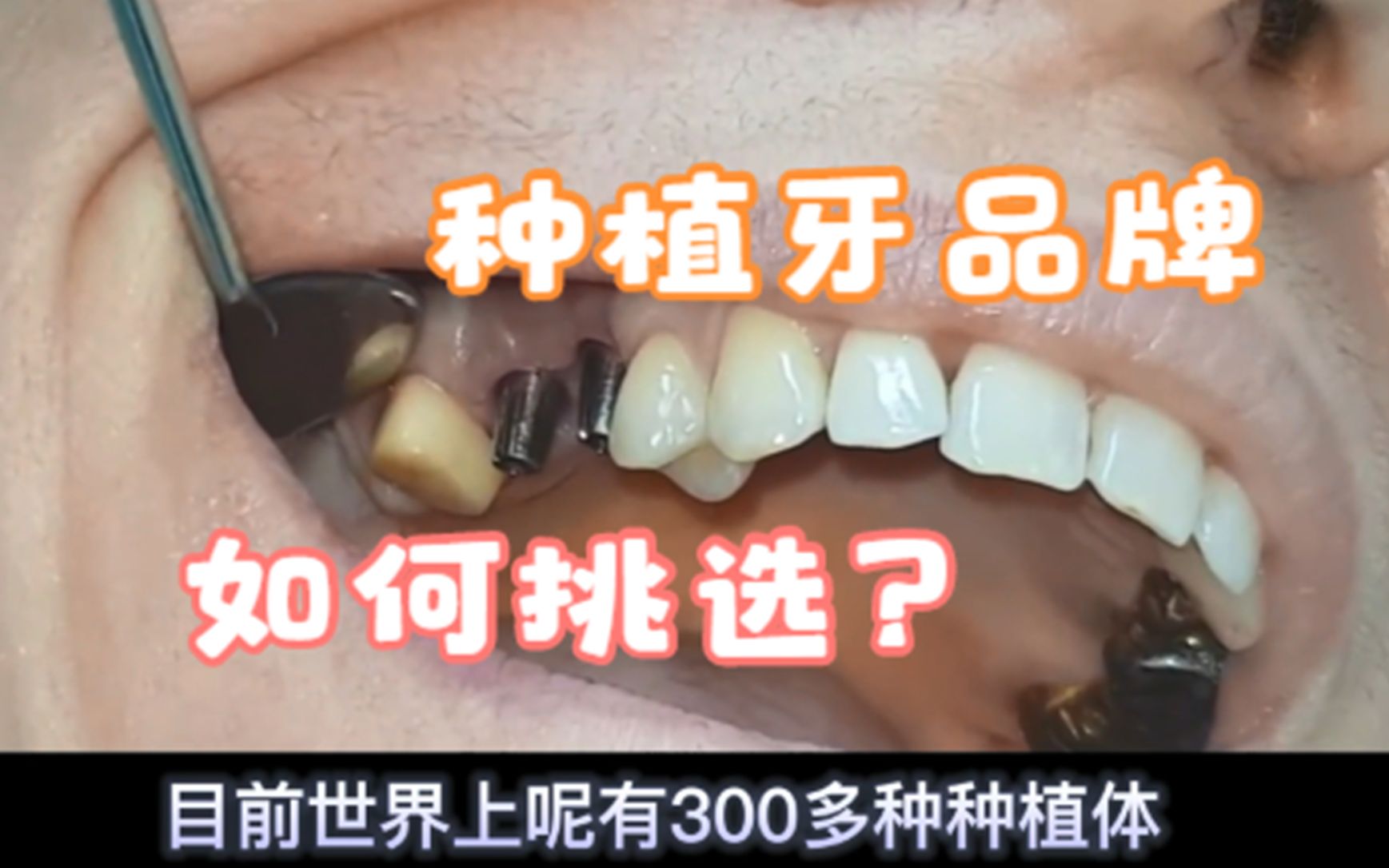 种植牙品牌那么多?我该怎么选?国产好还是欧美好还是韩国好?