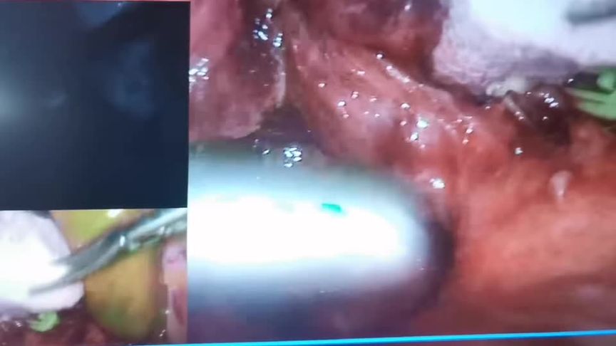 胆囊腐朽了,如果没有ERCP置入的支架,会非常担心腹腔镜下的清理