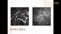 角膜共聚焦显微镜的临床应用(王姝婷)