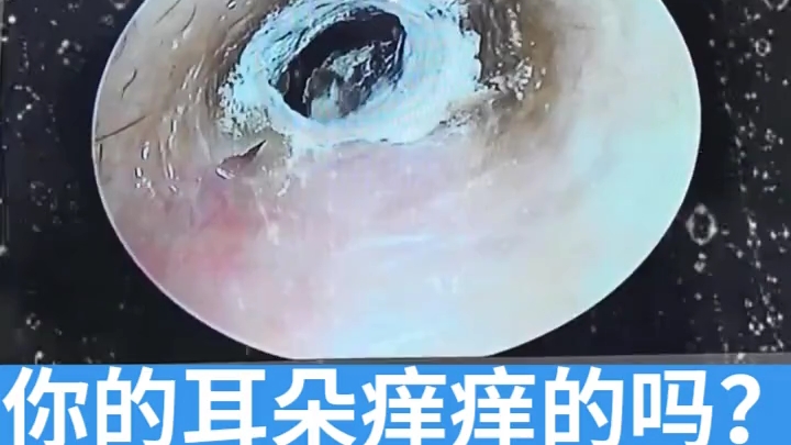 自己用棉花棒采耳的后果,太严重了,霉菌感染,太遭罪了