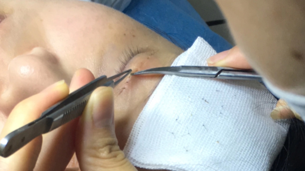 近距离看双眼皮拆线。精细的美容缝合,拆线后只有一条浅浅的痕迹