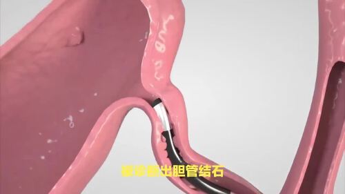 胆胰治疗革命!ERCP技术如何颠覆传统拯救生命?