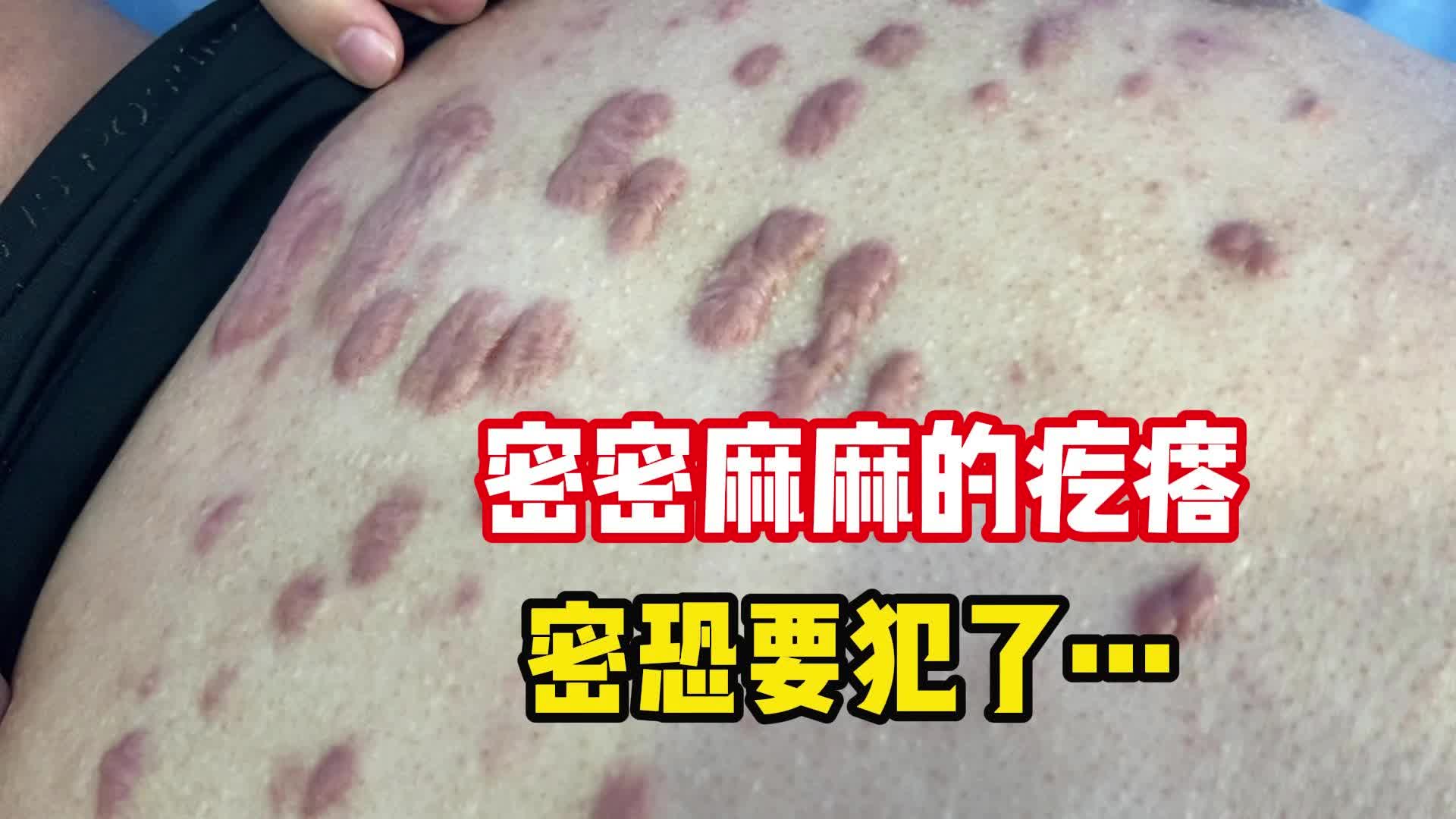 毛囊炎+疤痕疙瘩体质+封闭针=爆发密密麻麻的疤痕疙瘩