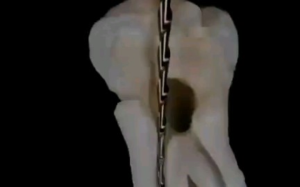 牙齿根管治疗术是通过彻底去除感染的牙髓以及感染的牙本质和毒性...