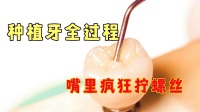 你种过牙吗,需要把牙槽骨上钻孔按螺丝,过程真解压